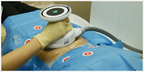 UltraShape – Nobel Medical Group