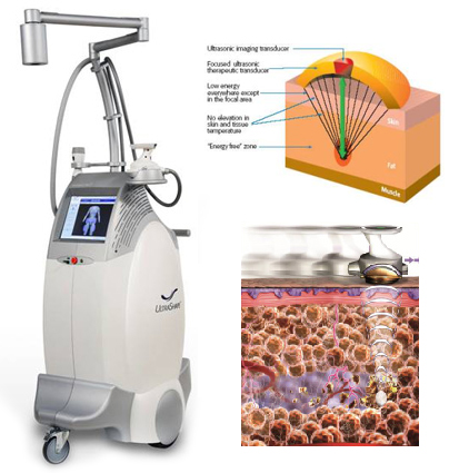 UltraShape – Nobel Medical Group