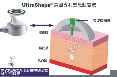 UltraShape – Nobel Medical Group