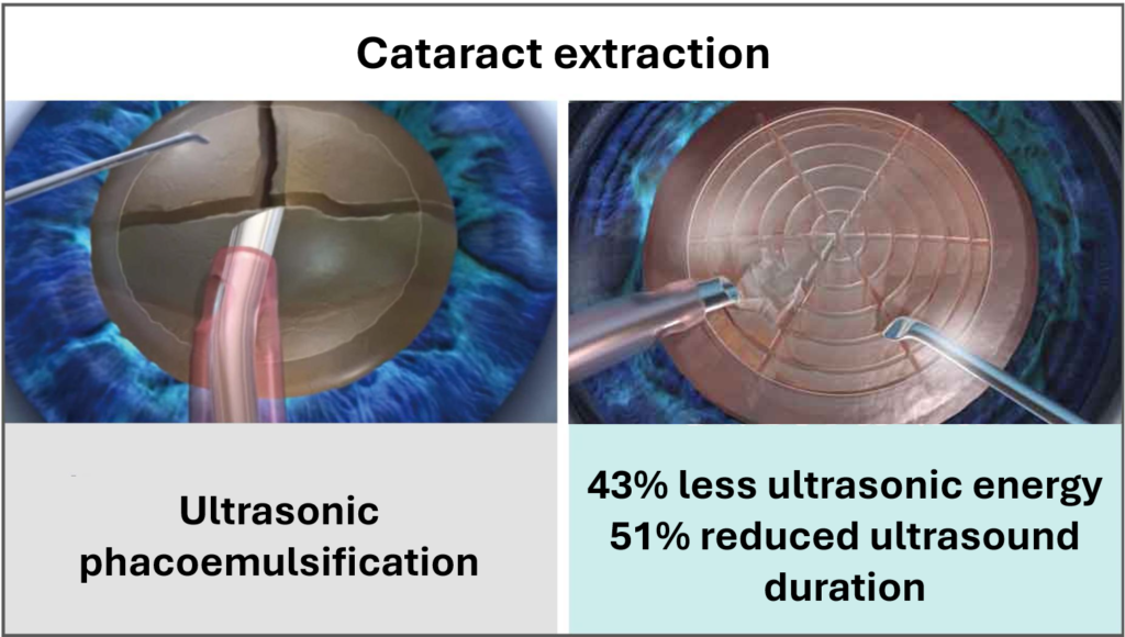 Femtosecond Cataract Surgery – Nobel Medical Group