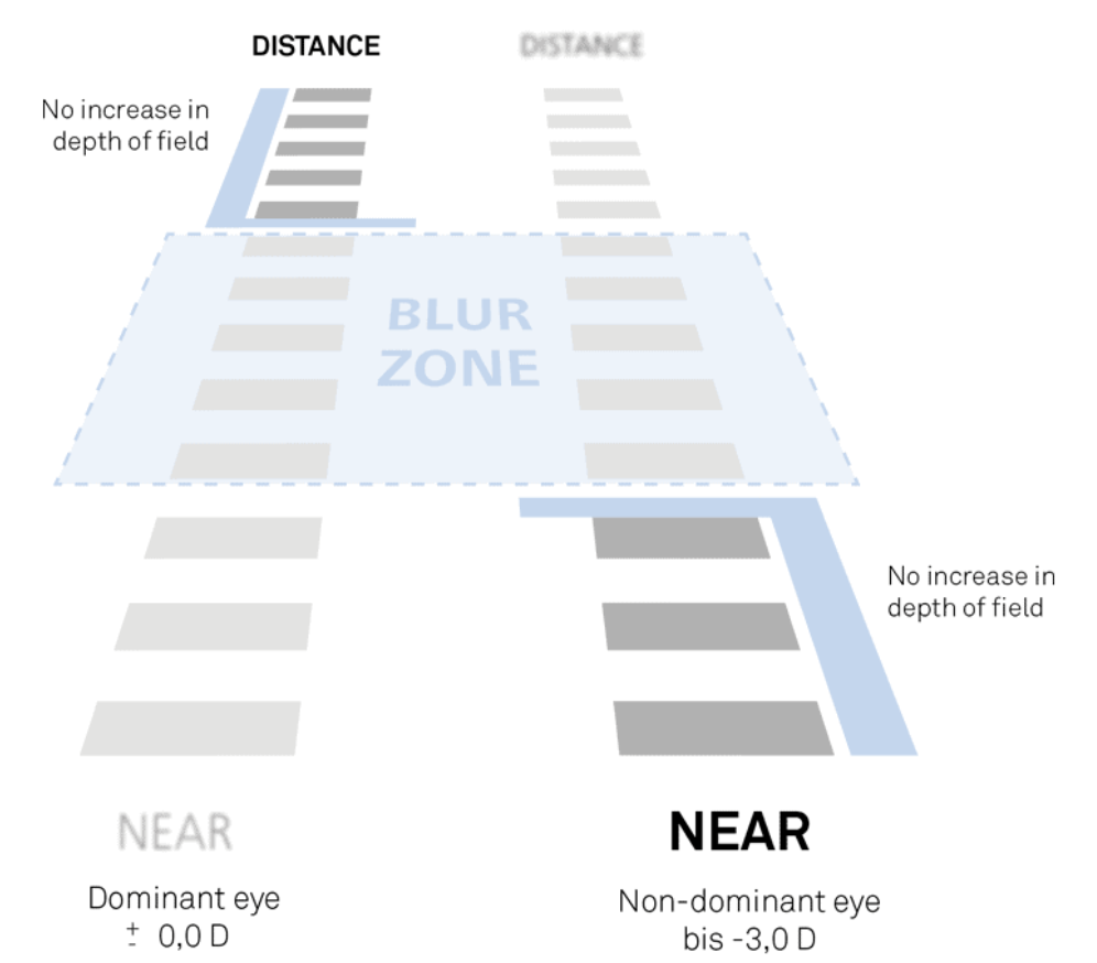 Laser Presbyopia Correction – Nobel Medical Group